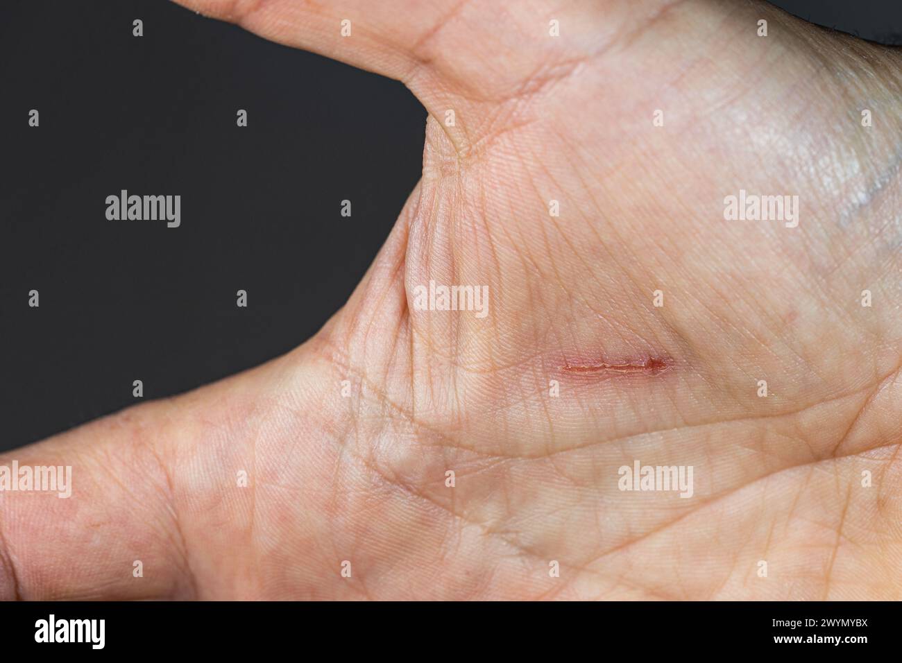 Part of human hand palm with wound caused by plant spikes Stock Photo ...