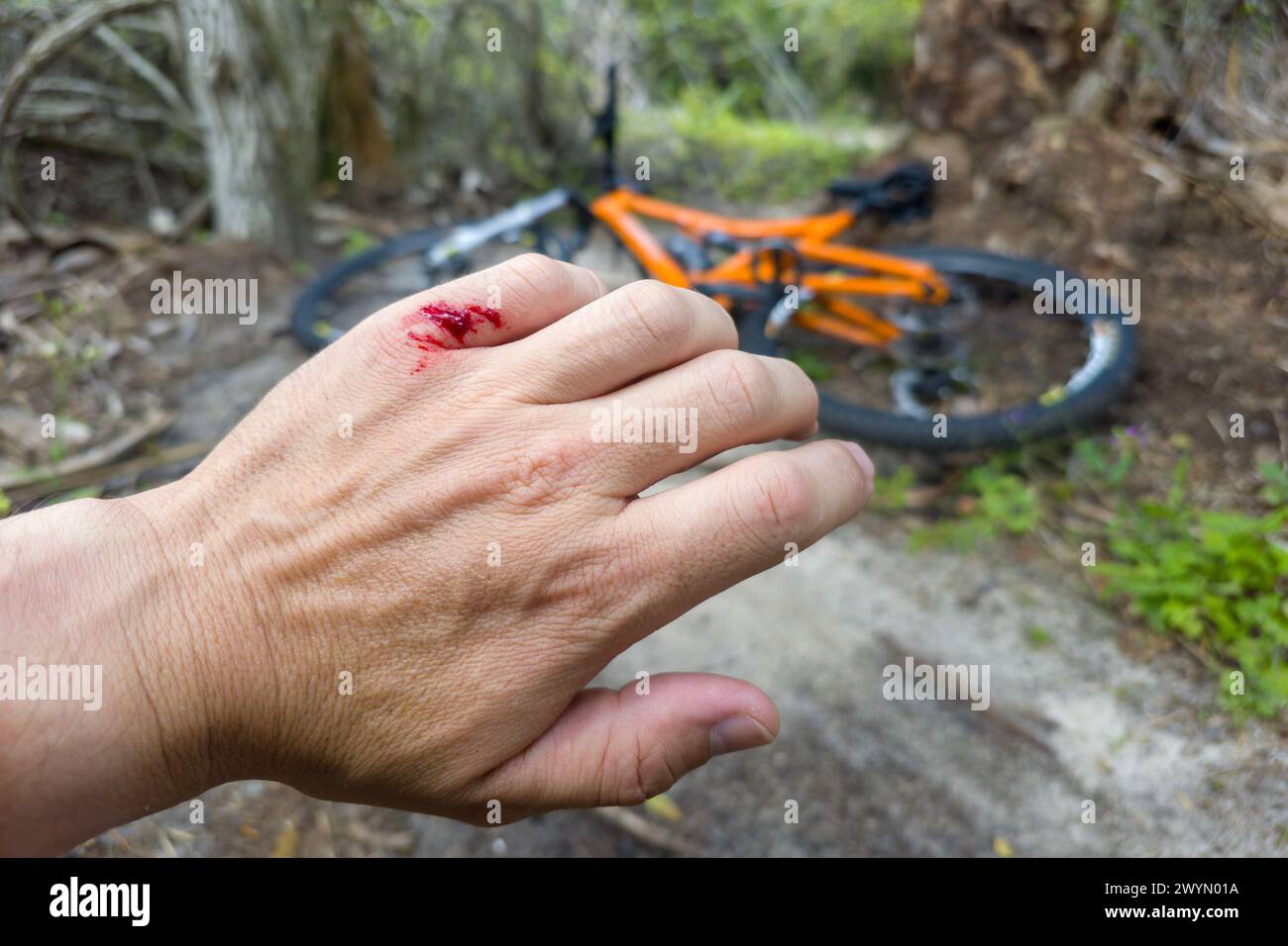 Mountain bike accident. Rider hand wound with red blood from hitting a ...