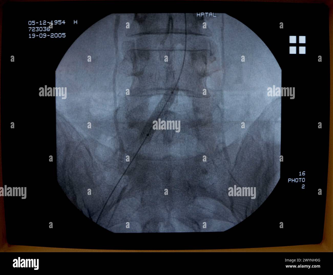 Interventional angiography hi-res stock photography and images - Alamy
