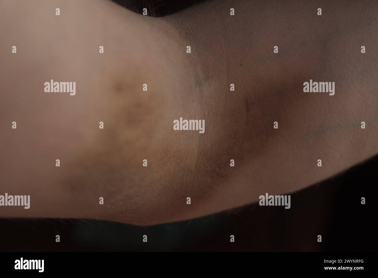 Closeup young man hand with bruise after injection Stock Photo - Alamy