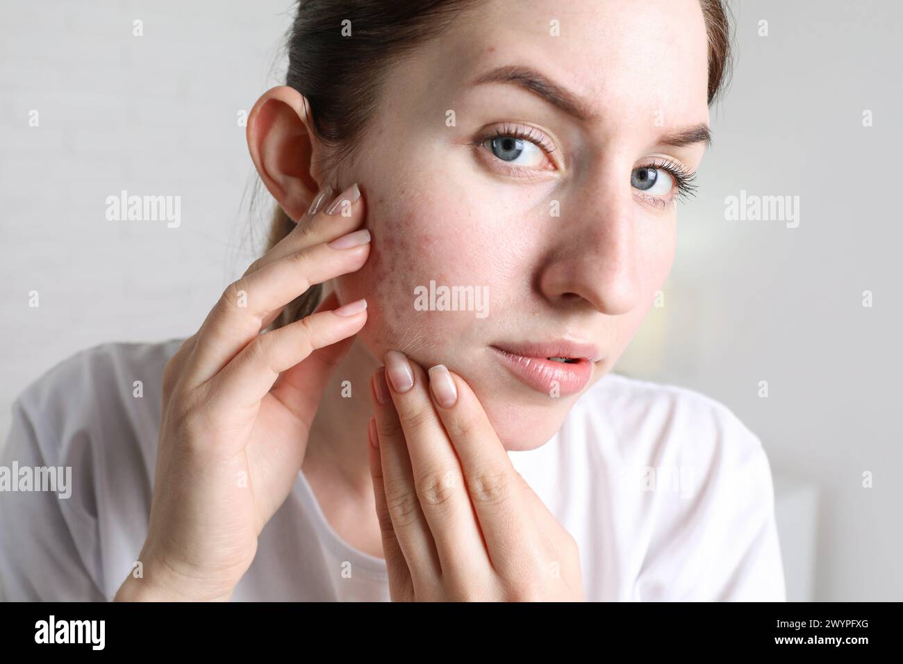 Acne medicine hi-res stock photography and images - Alamy