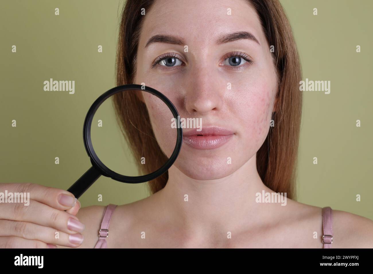Young woman with acne problem holding magnifying glass near her skin on ...