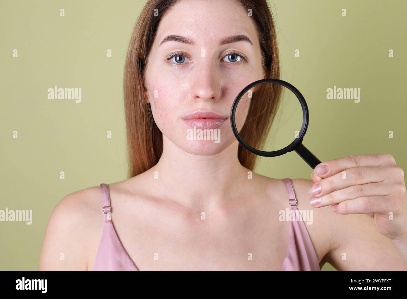 Young woman with acne problem holding magnifying glass near her skin on ...