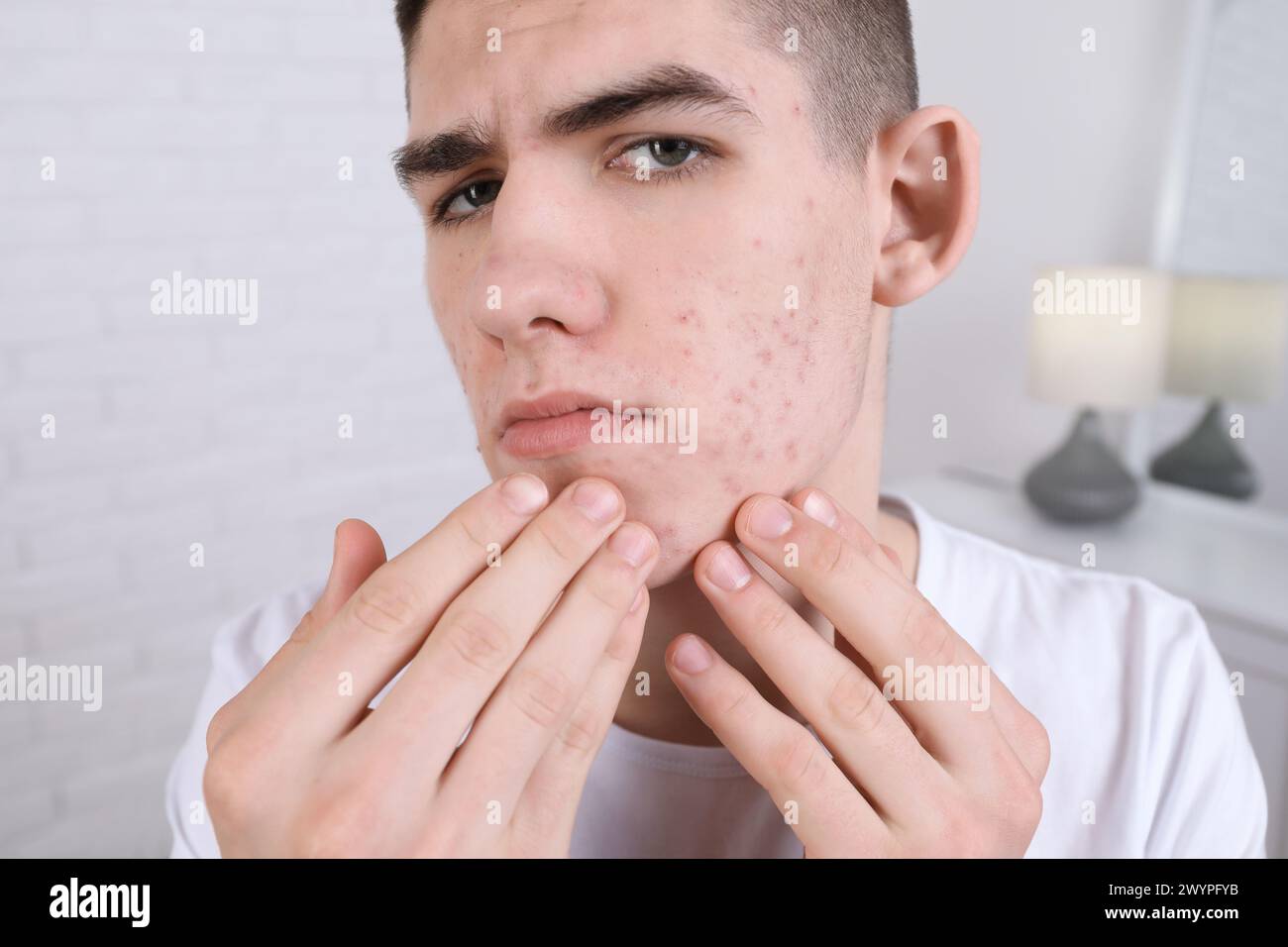 Upset young man touching pimple on his face indoors. Acne problem Stock ...