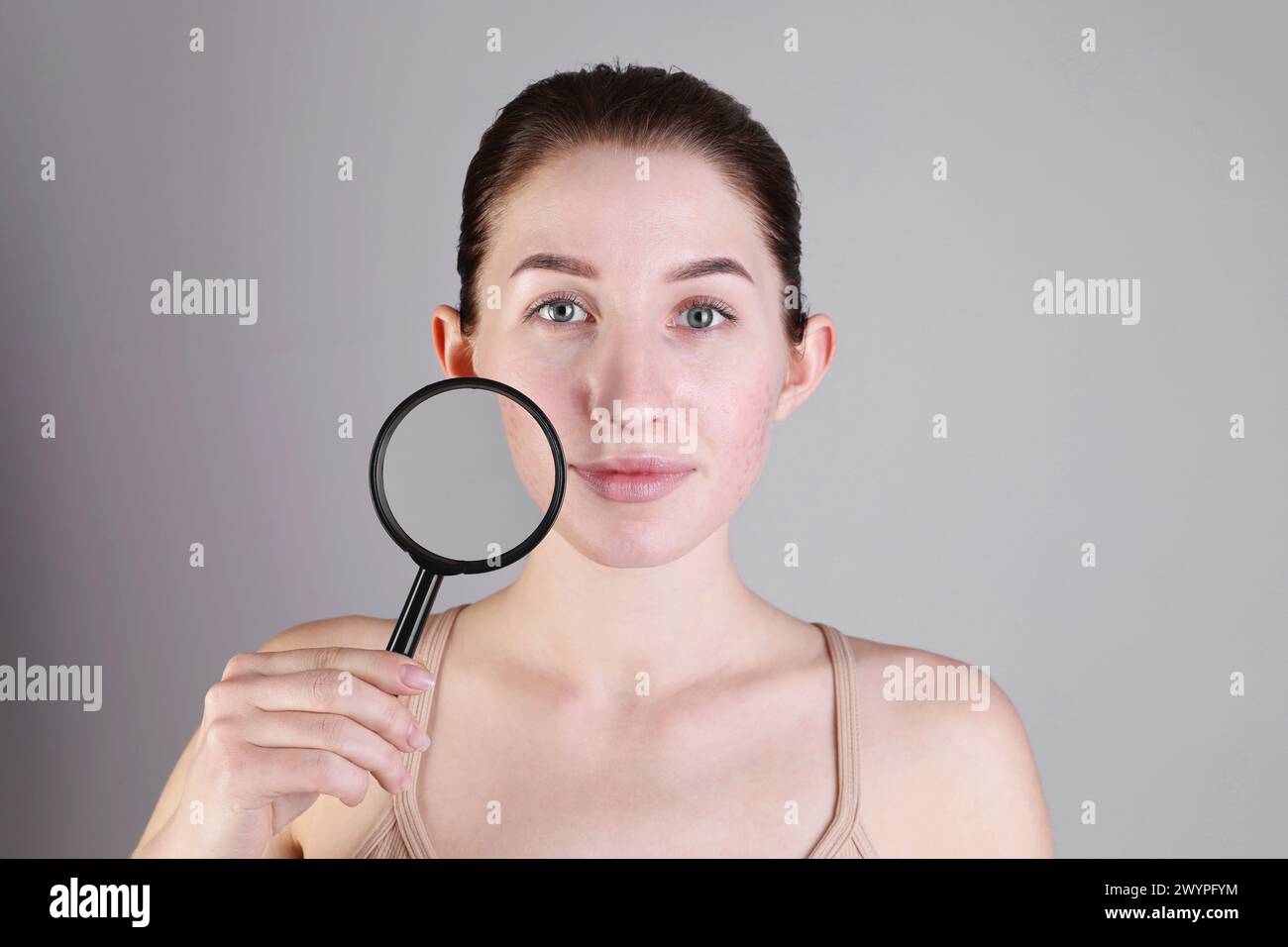 Young woman with acne problem holding magnifying glass near her skin on ...