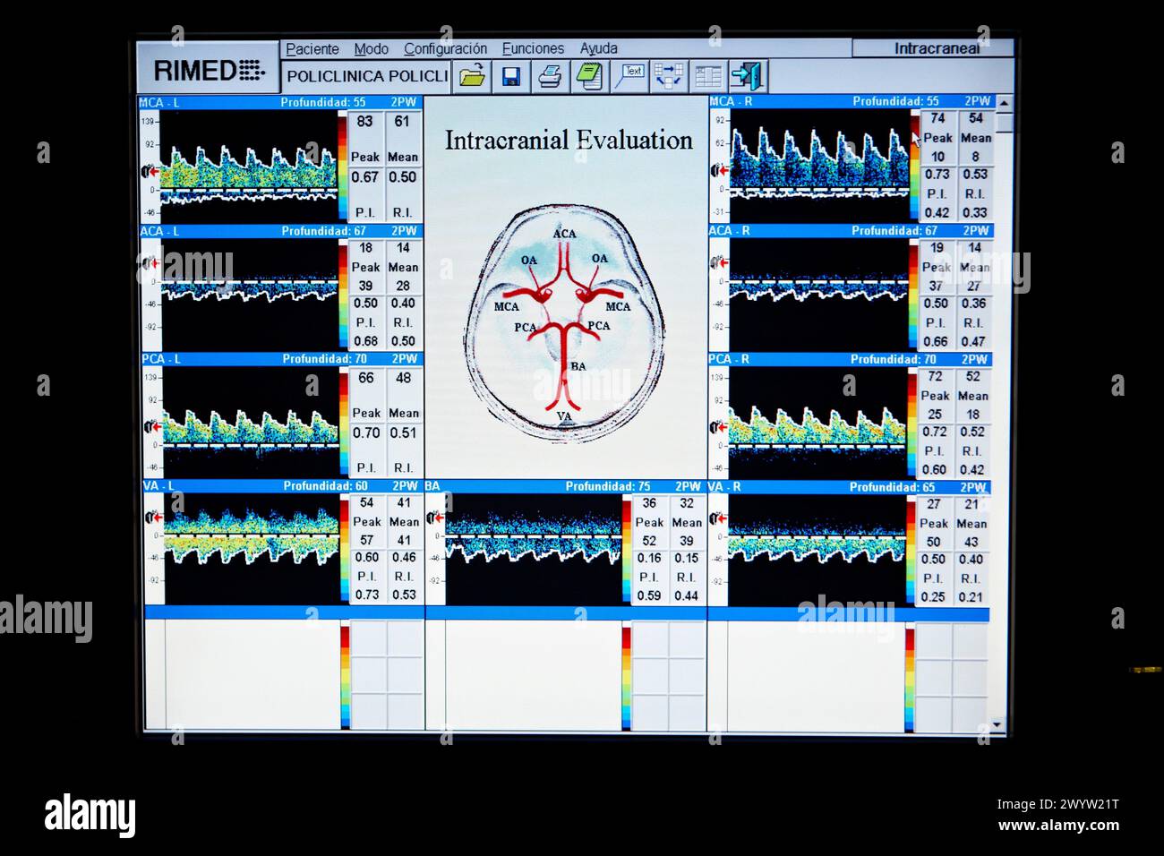 Transcranial doppler, Neurological examination. Hospital Policlinica ...