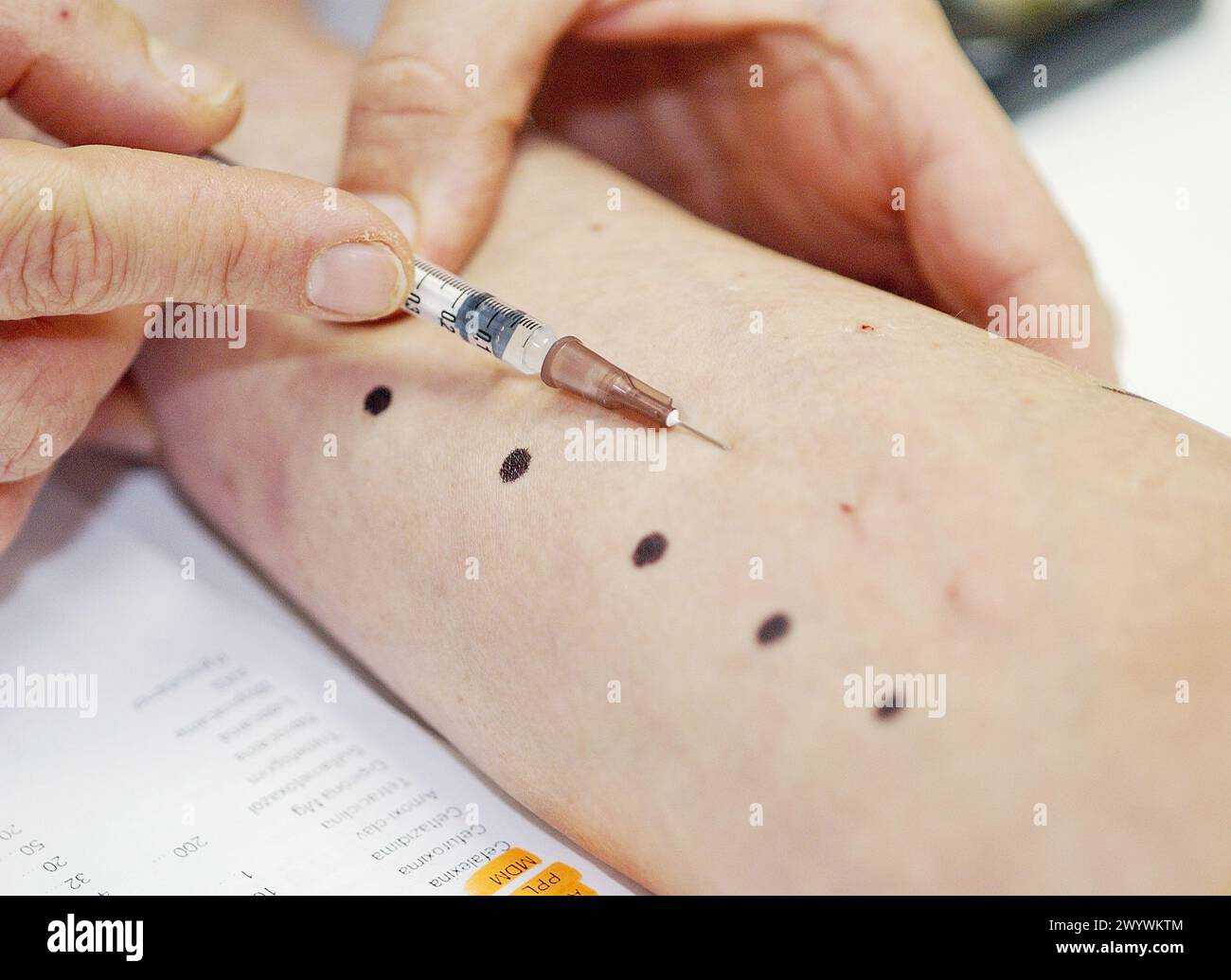 Allergy test arm patient hi-res stock photography and images - Alamy