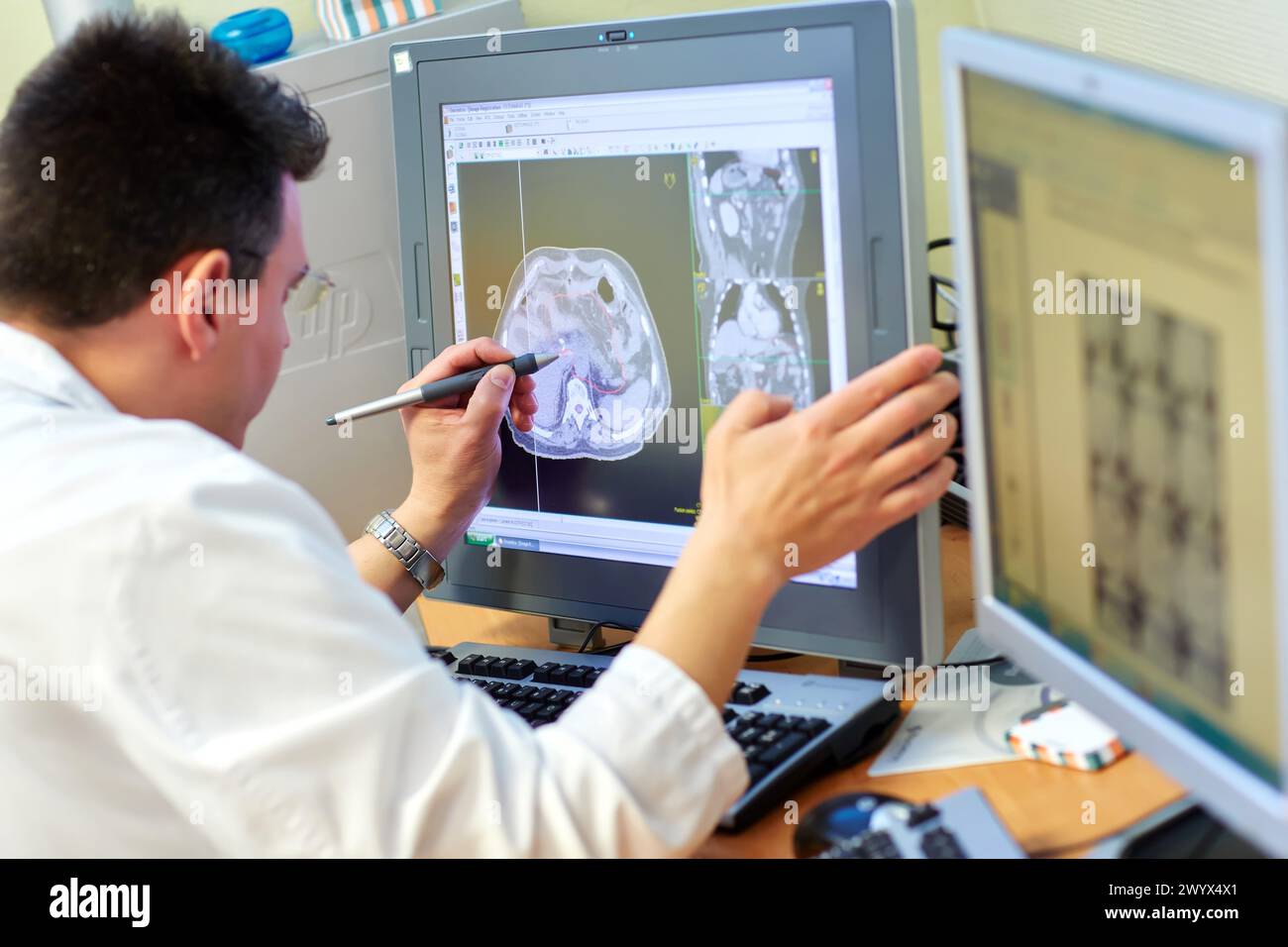 IMRT, Intensity Modulated Radiation Therapy, abdomen Cancer 3D ...