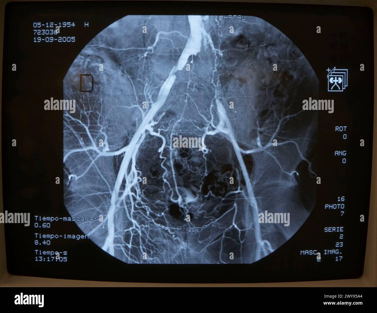 Interventional angiography hi-res stock photography and images - Alamy