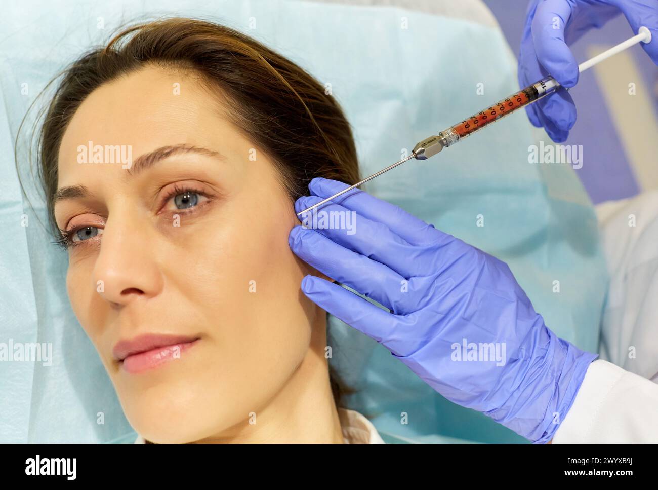 Lipofilling. Fat Grafting. Liposculpture. Lipofilling is based on ...