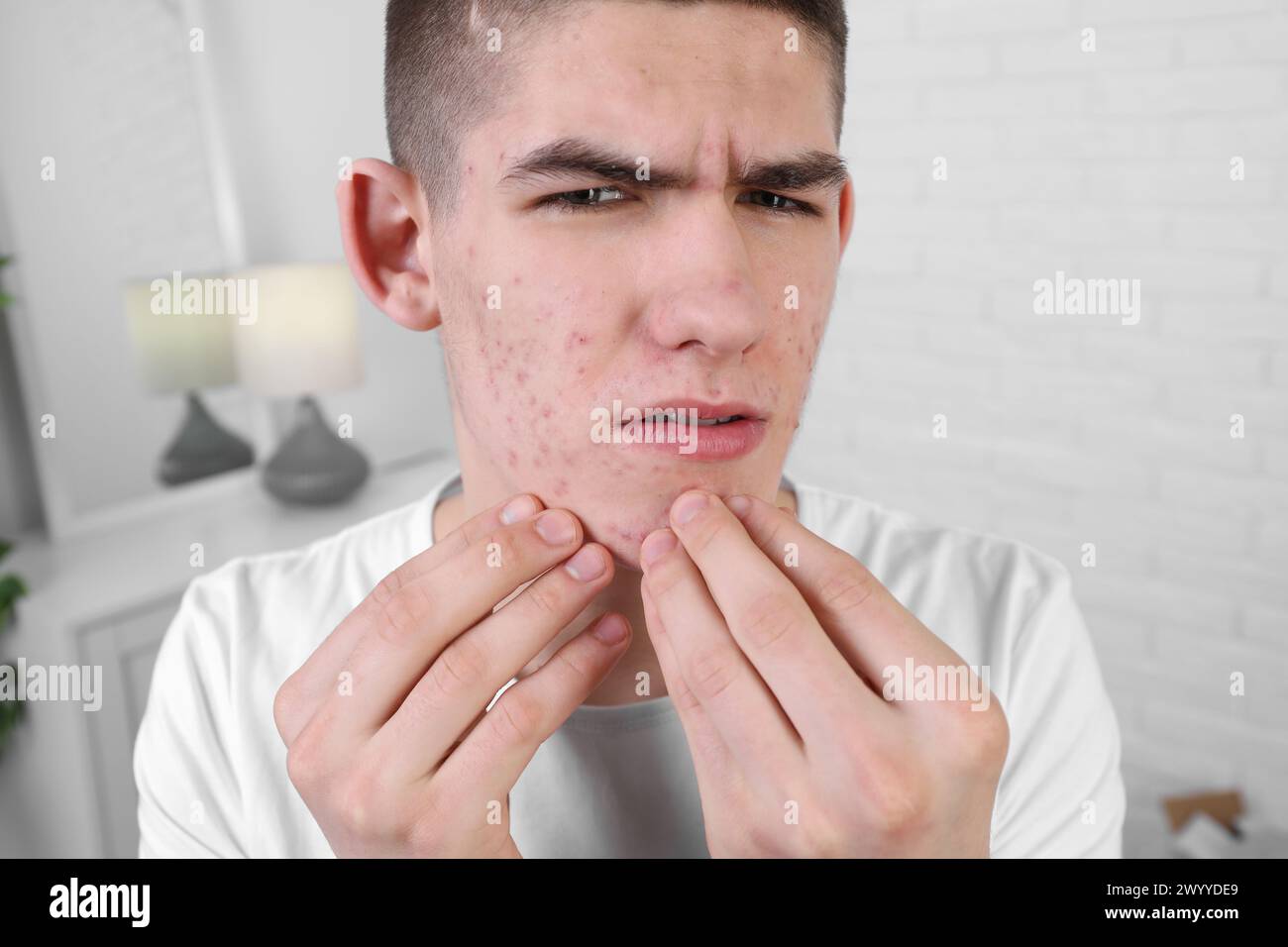 Upset young man touching pimple on his face indoors. Acne problem Stock ...