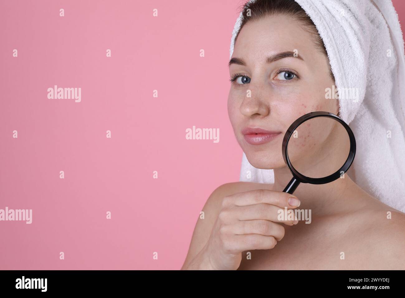 Young woman with acne problem holding magnifying glass near her skin on ...