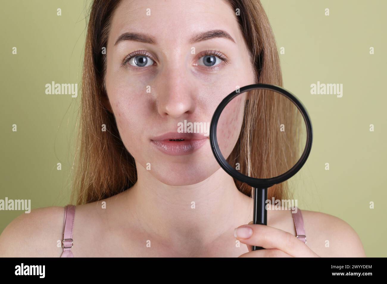 Young woman with acne problem holding magnifying glass near her skin on ...