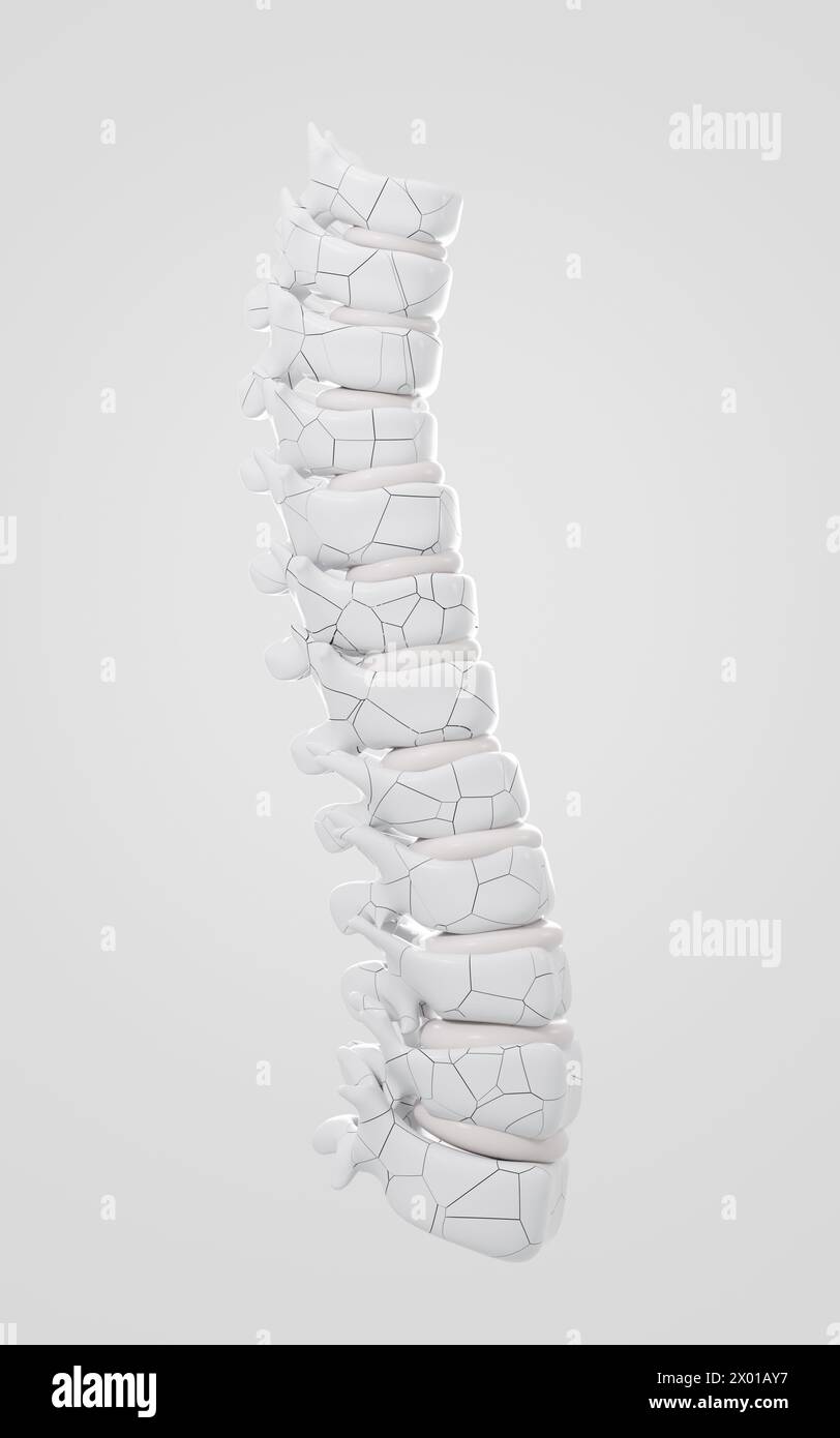 Models of human vertebrae and fractures, 3d rendering. 3d illustration ...