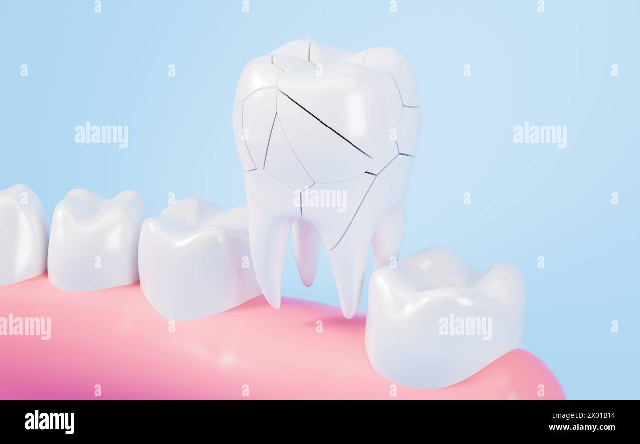 Human tooth model, tooth cracking, oral rehabilitation, 3d rendering ...