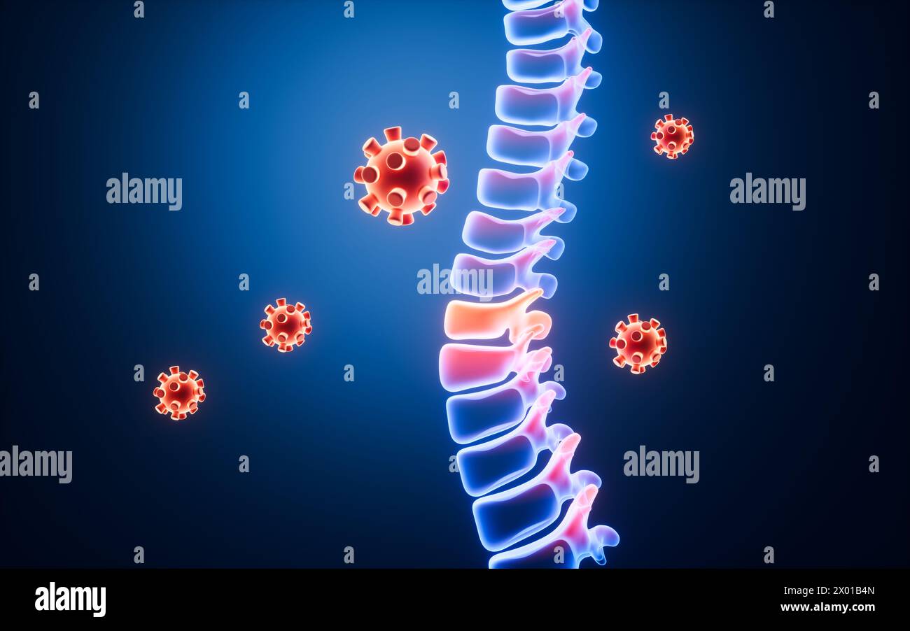 Human spine inflammation and viral infection, 3d rendering. 3d ...