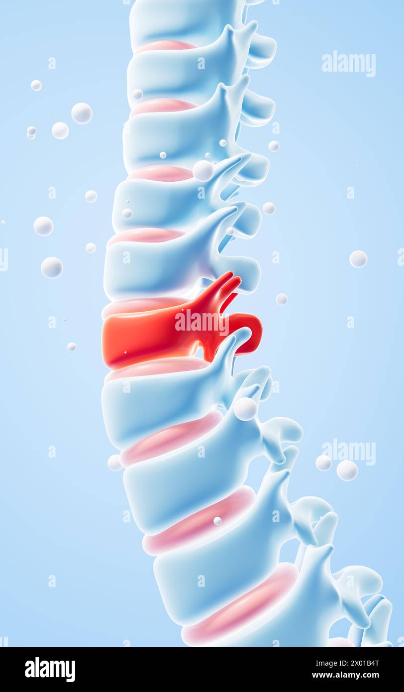 Inflammation of the human spine, Medical concept, 3d rendering. 3d ...