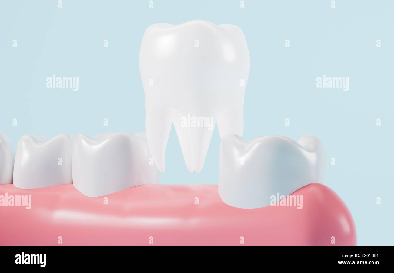 Human tooth model, tooth implantation, orthodontics, 3d rendering. 3d ...
