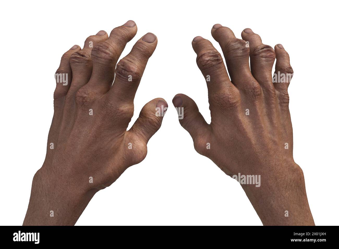 Illustration of gout-afflicted hands with deformities, revealing the ...