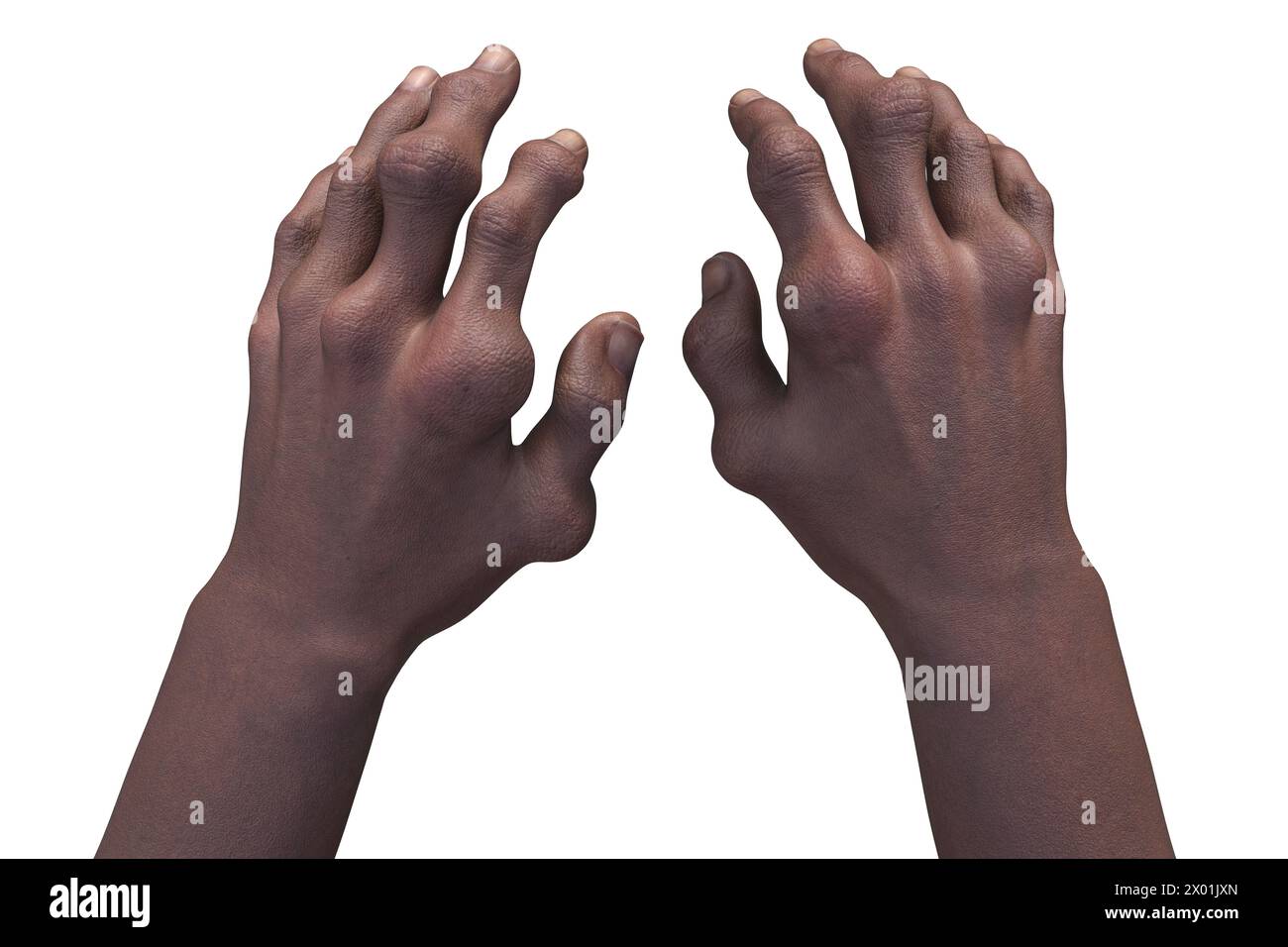 Illustration of gout-afflicted hands with deformities, revealing the ...