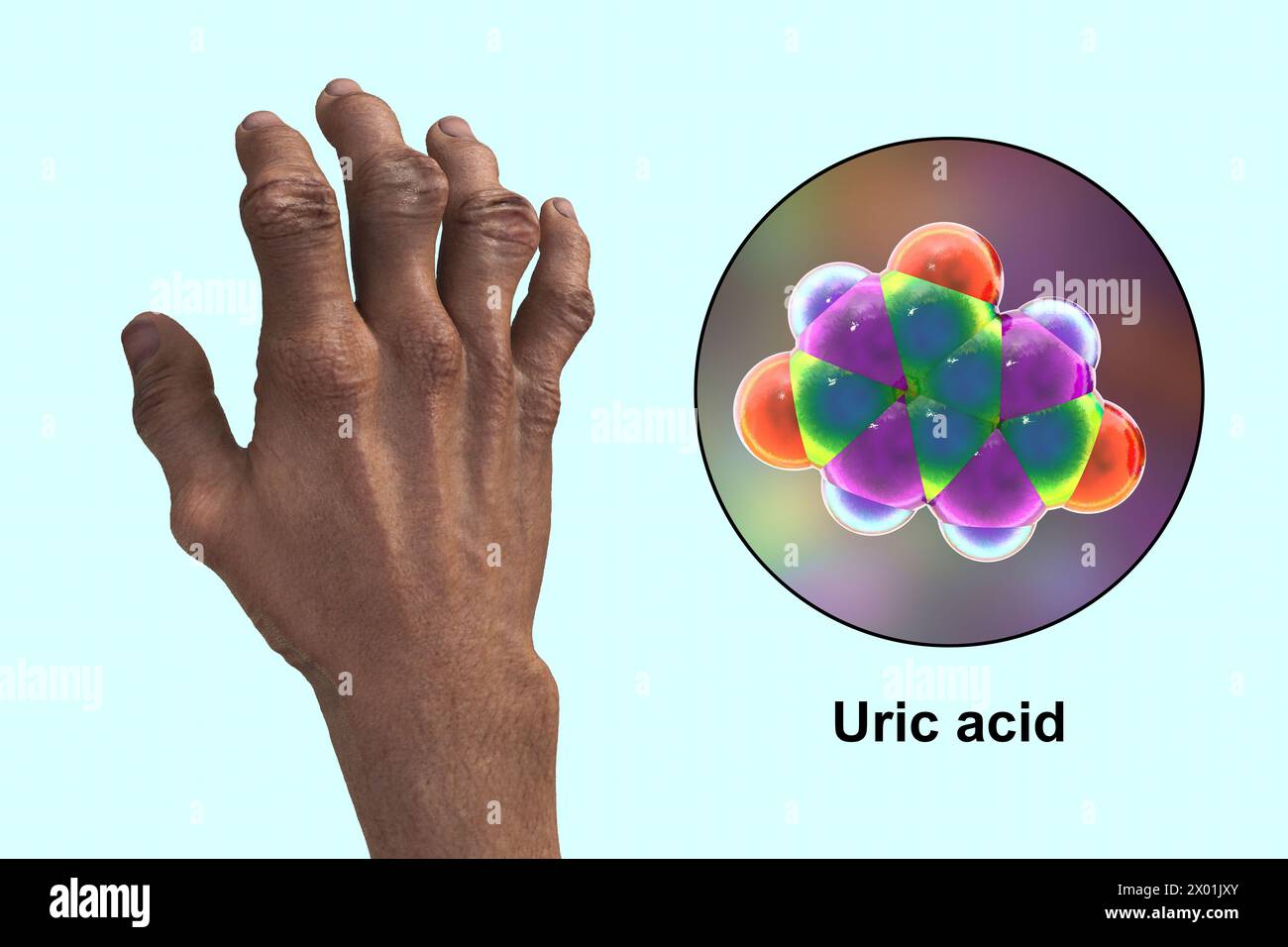 Illustration of gout-afflicted hands with deformities and close-up view ...