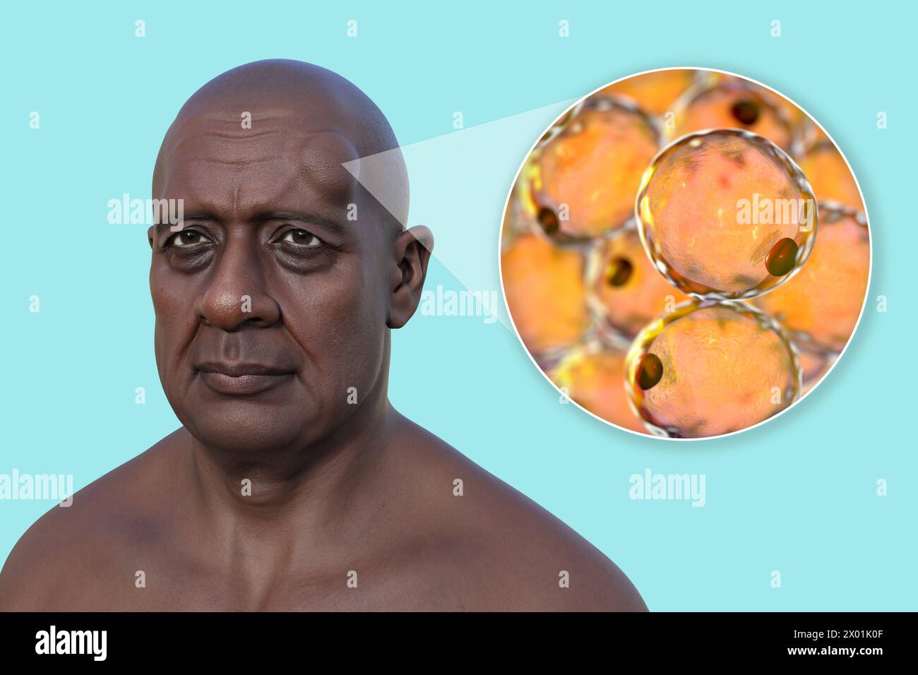 Illustration of lipoma on a man's forehead, and close-up view of ...