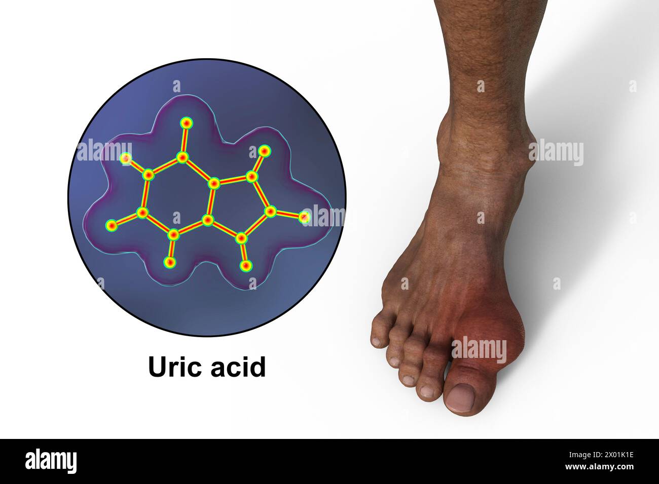 Illustration of gout-afflicted foot and close-up view of uric acid ...