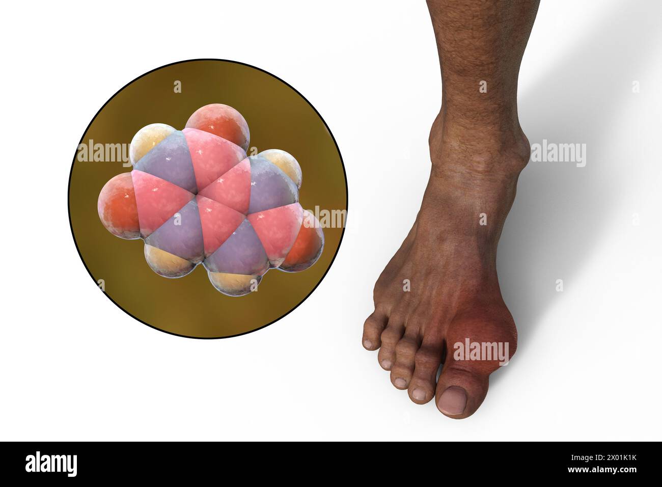 Illustration of gout-afflicted foot and close-up view of uric acid ...