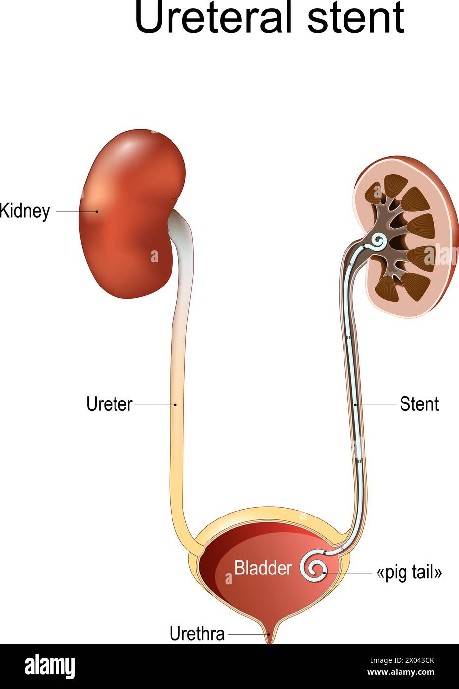 Ureteral stent. Renal colic. Human Urinary System. cross section of a kidney and bladder with ...