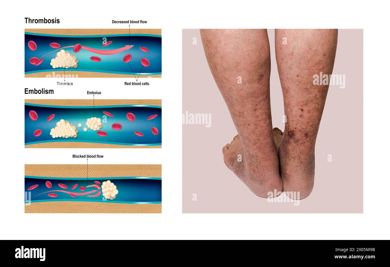 Deep Vein Thrombosis or Blood Clots. Embolus. Structure of normal and ...