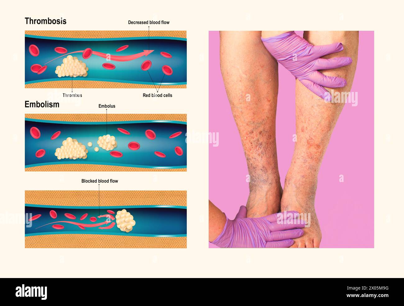 Deep Vein Thrombosis or Blood Clots. Embolus. Structure of normal and ...
