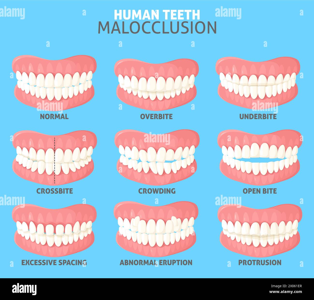 Different human teeth malocclusion types front view set Stock Vector ... Different human teeth malocclusion types front view set Stock Vector ...