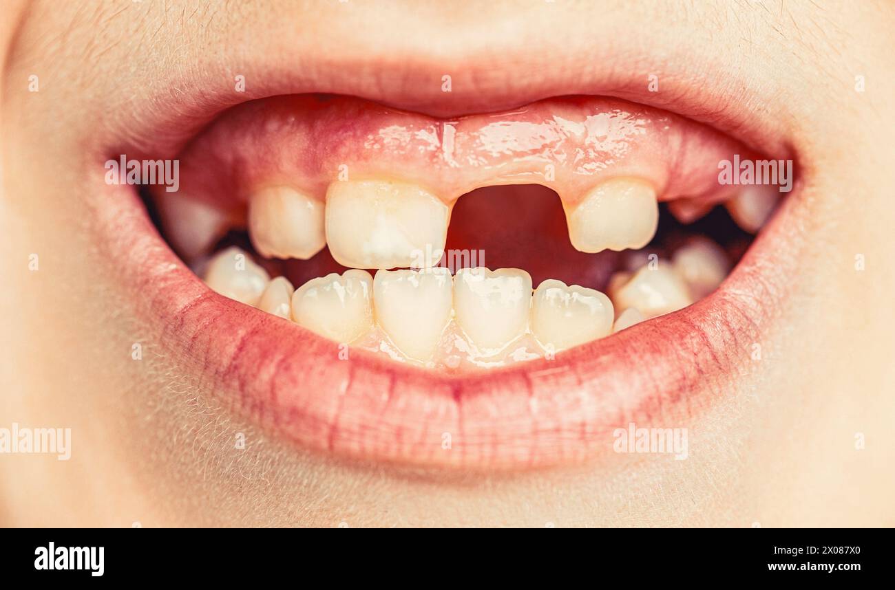 Boy kid lost front tooth, toothache. Close up of unhealthy baby teeths ...