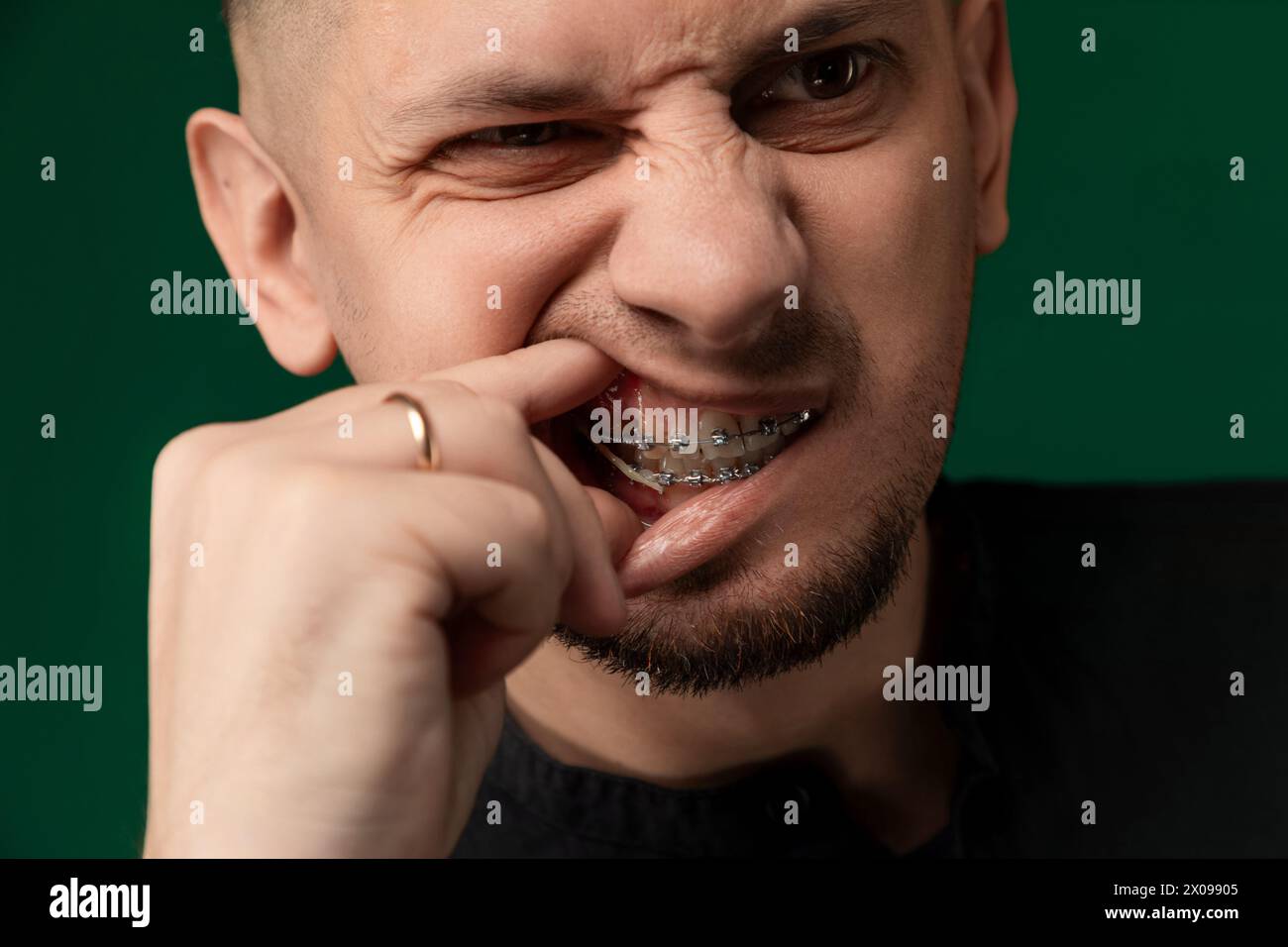 A man with braces on his teeth is playfully contorting his face ...