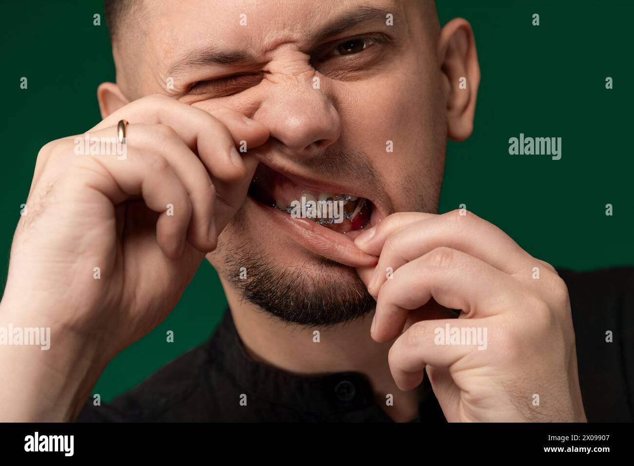 Man With Braces Making Silly Face Stock Photo - Alamy