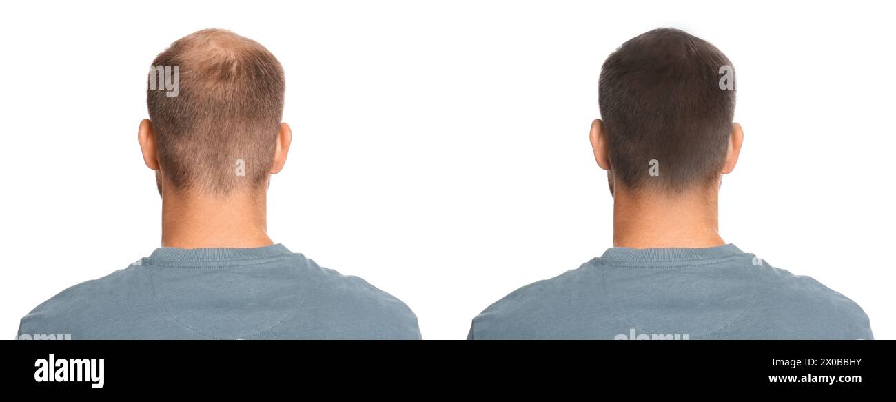 Man before and after hair treatment with high frequency darsonval ...