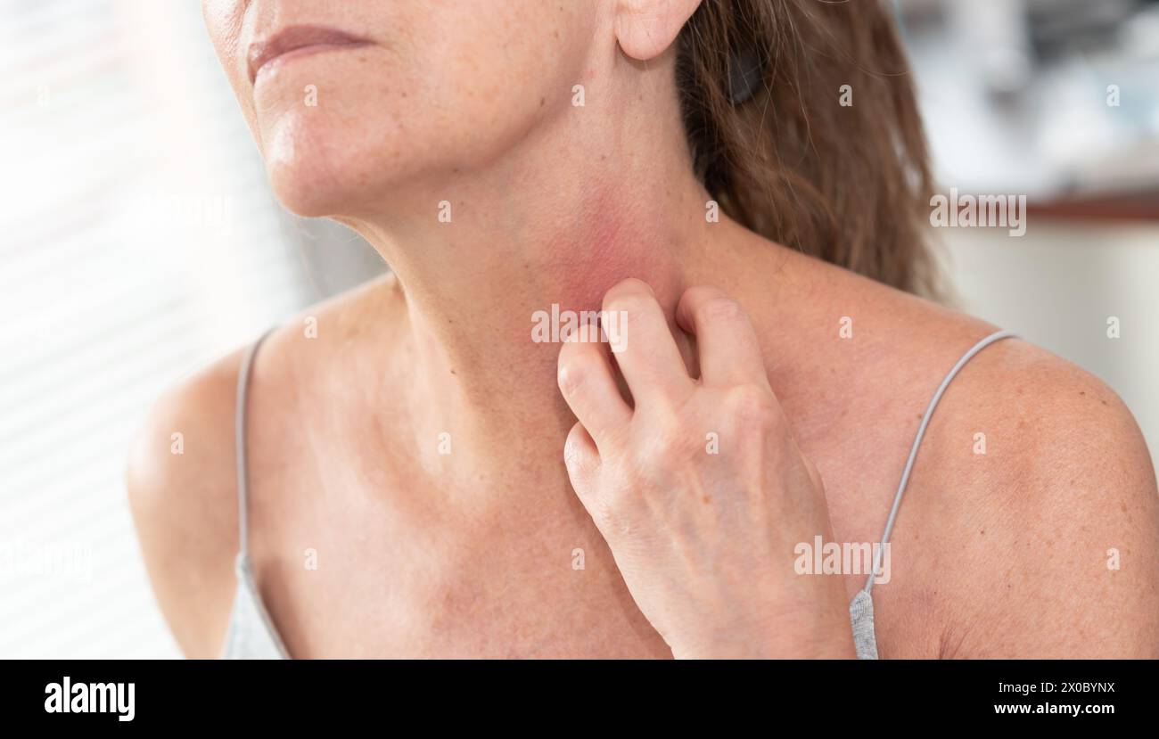 Woman having itchy and scratching her neck. Allergy symptoms Stock Photo - Alamy