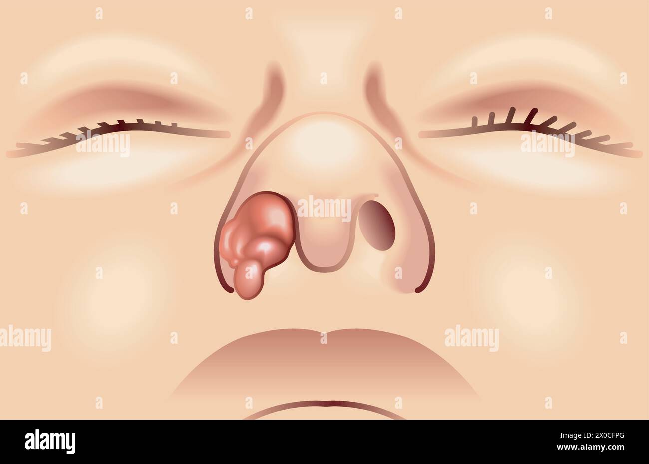 Medical illustration of a nasal tumor Stock Vector Image & Art - Alamy
