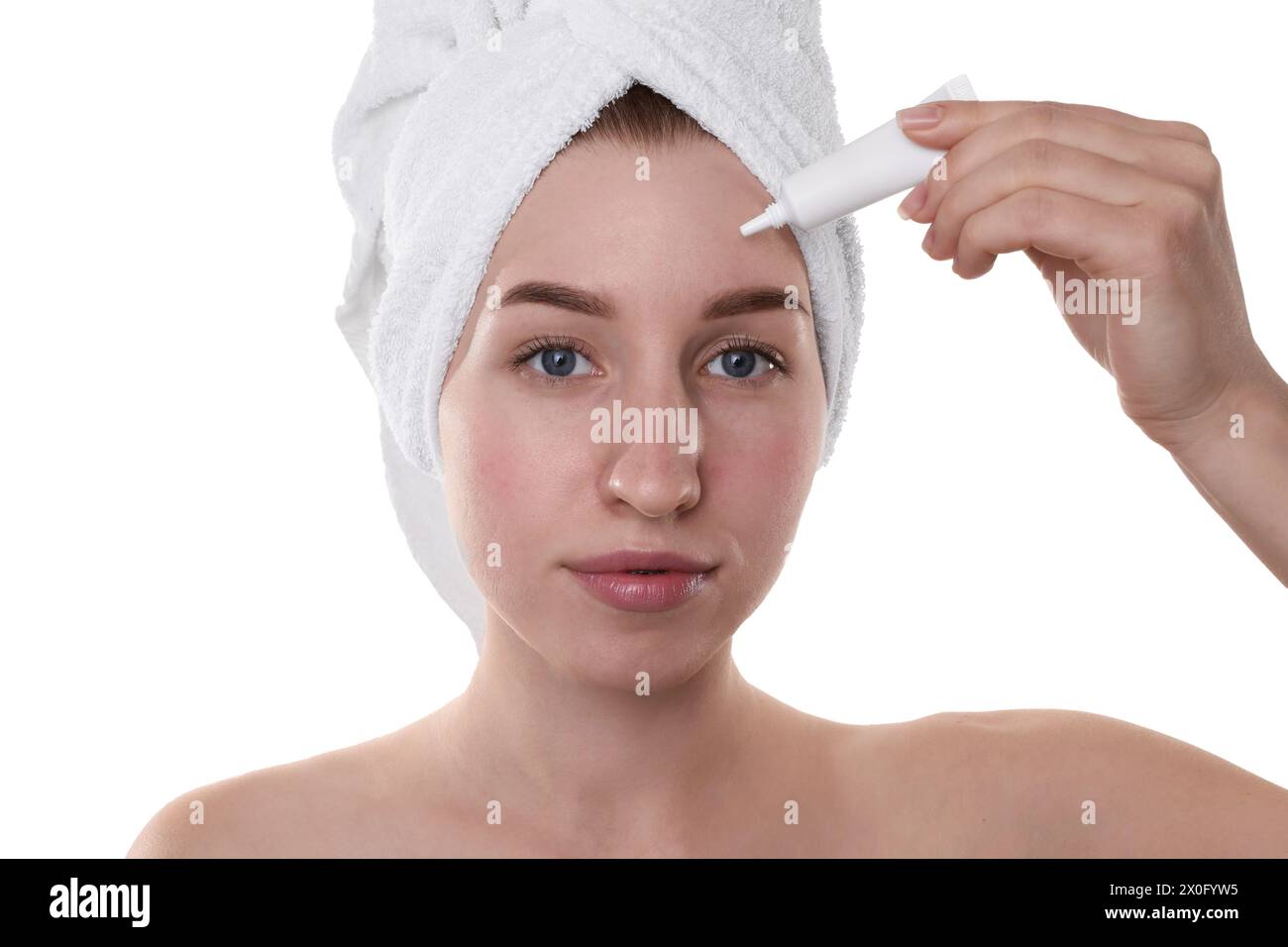 Young woman with acne problem applying cosmetic product onto her skin ...