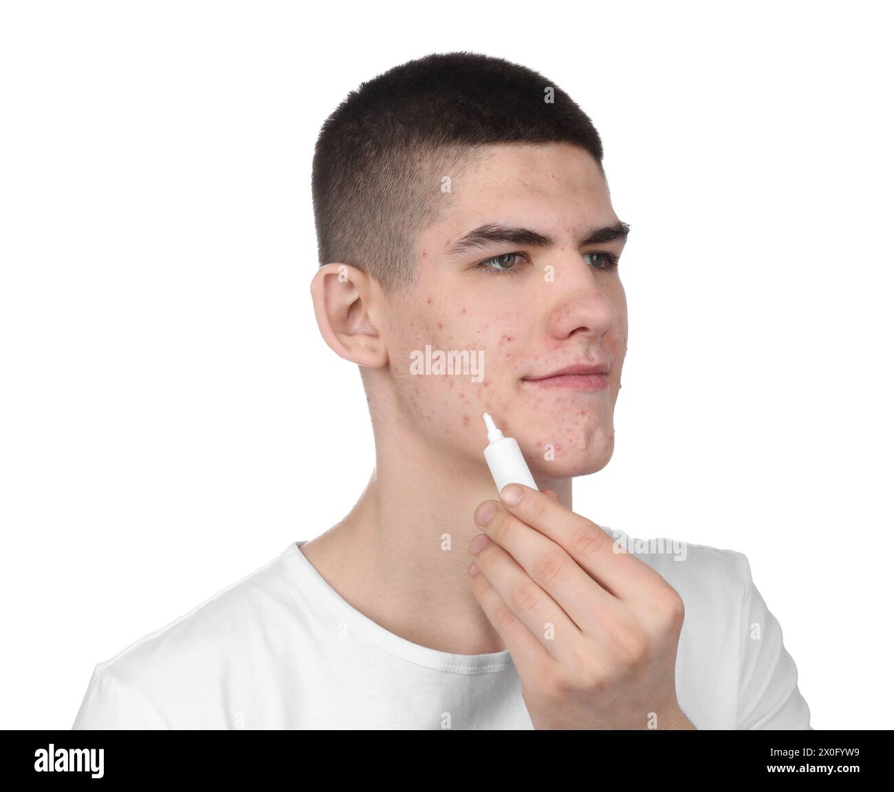 Young man with acne problem applying cosmetic product onto his skin on ...