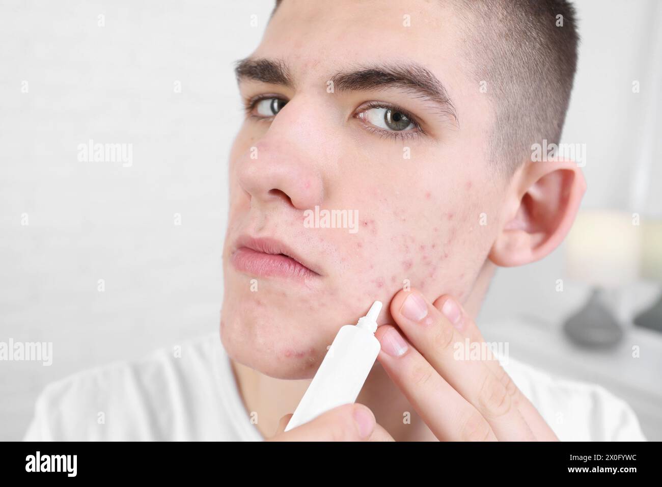 Young man with acne problem applying cosmetic product onto his skin ...