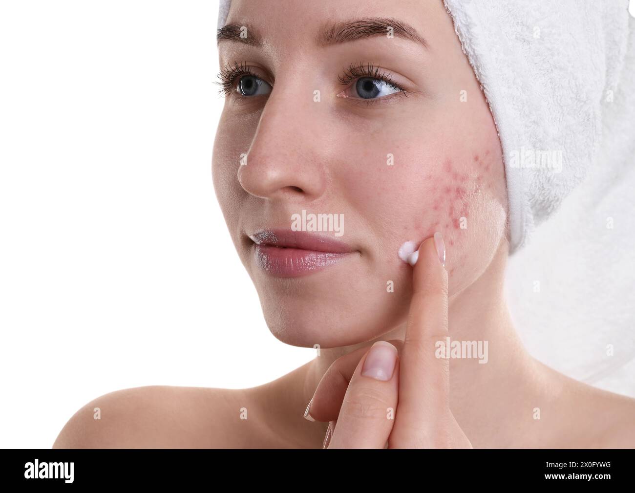 Young woman with acne problem applying cosmetic product onto her skin ...