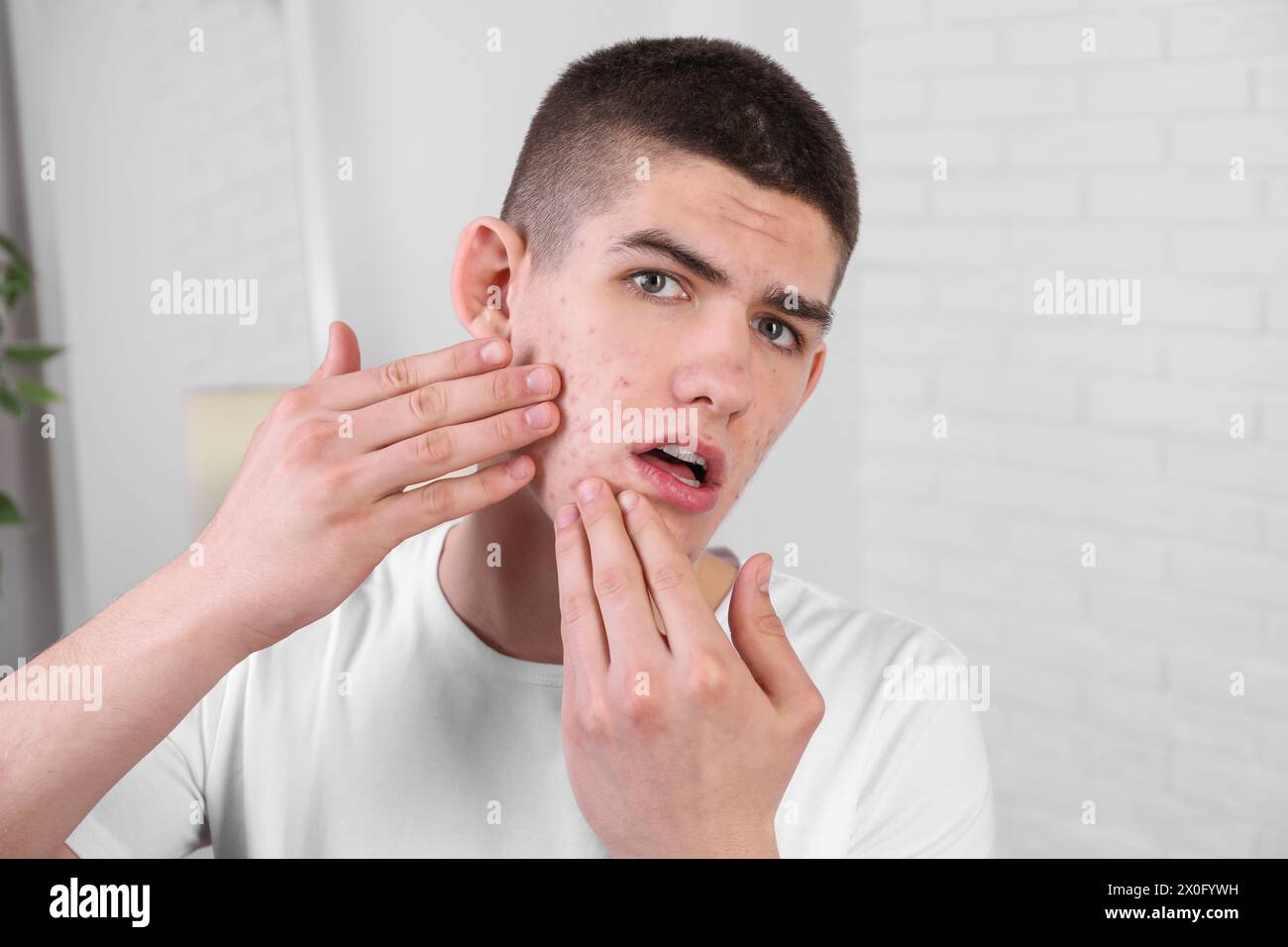 Upset young man touching pimple on his face indoors. Acne problem Stock ...