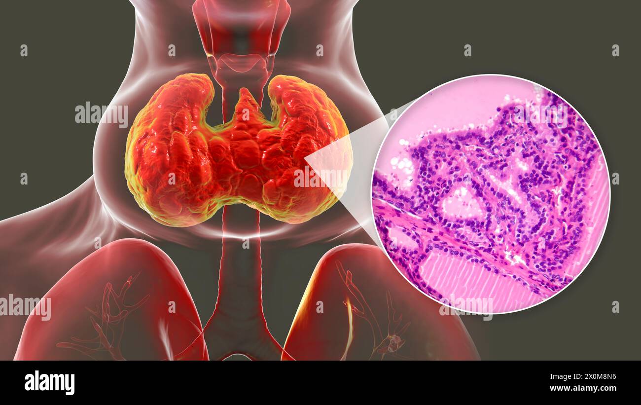 3D illustration of a person with a toxic goitre (enlarged thyroid gland ...