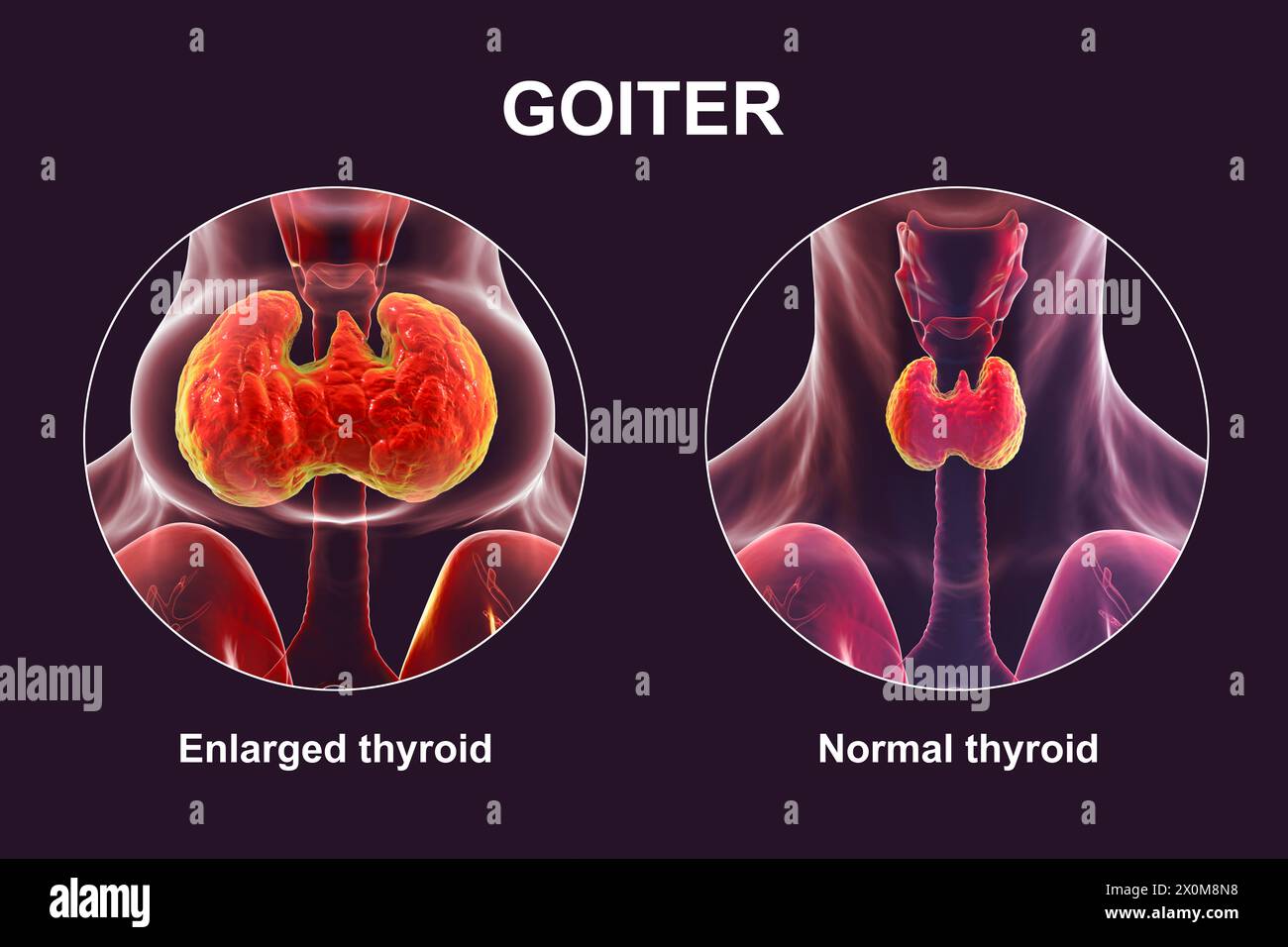 3D illustration of a person with an enlarged thyroid gland (base of ...
