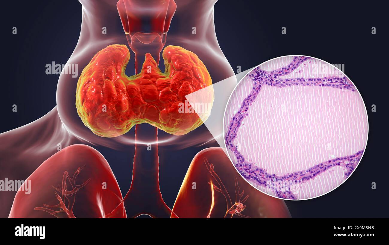 3D illustration of a person with an endemic goitre (enlarged thyroid ...