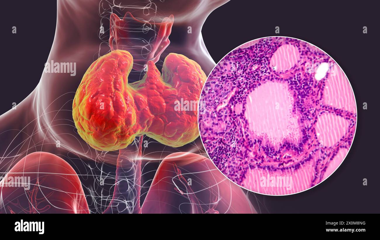 Goitre hi-res stock photography and images - Alamy