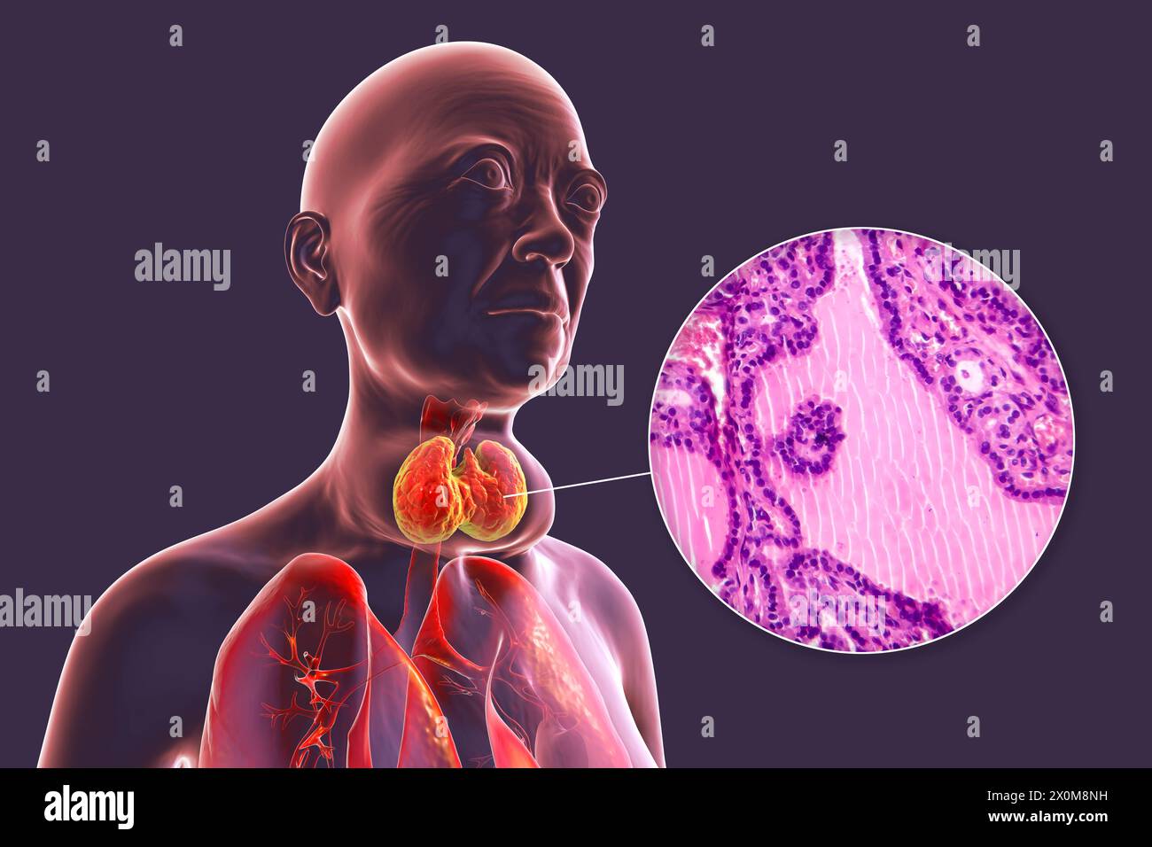 3D illustration of a person with a toxic goitre (enlarged thyroid gland ...