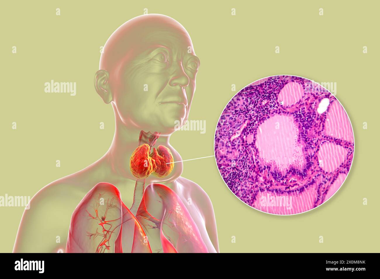 3D illustration of a person with a toxic goitre (enlarged thyroid gland ...