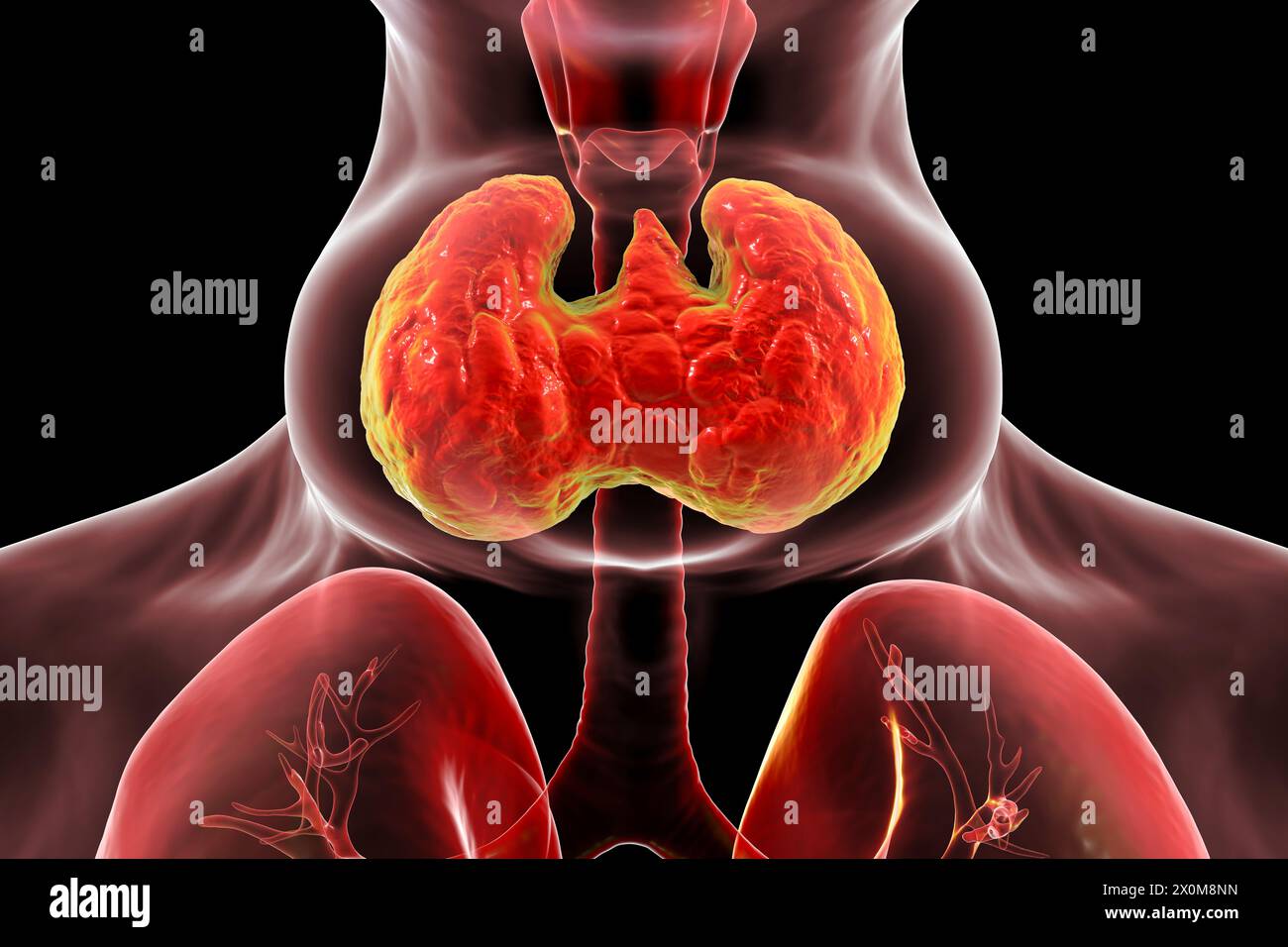 3D illustration of a woman with an enlarged thyroid gland, known as a ...